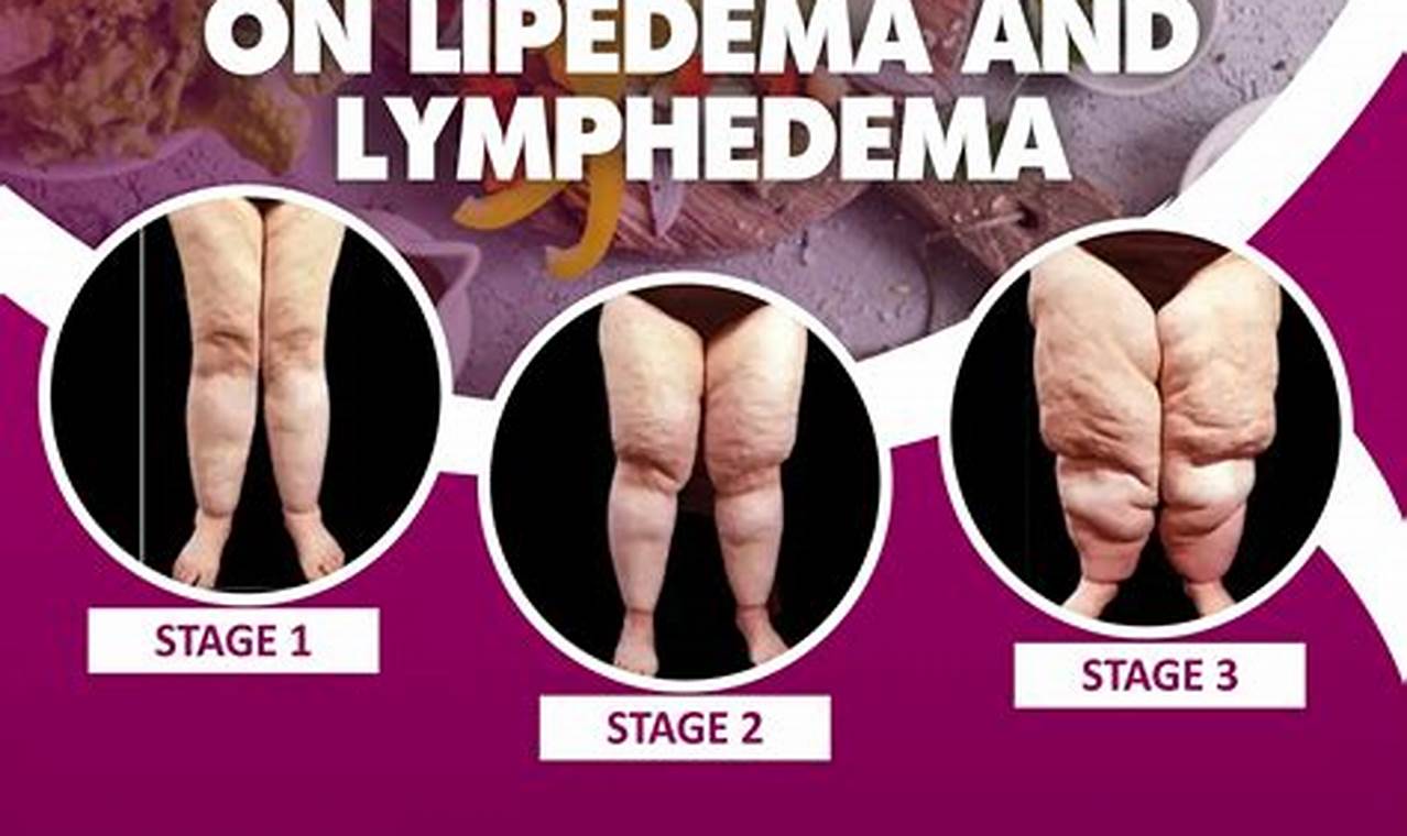 Natural Lipedema Herbal Treatment: Relief & Support